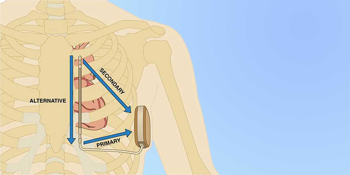 Εμφύτευση Απινιδωτών, Ενδοφλέβιων & Υποδόριων - Κολοβός Βασίλειος MD ...