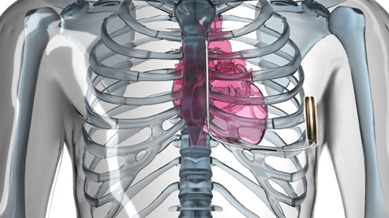 Εμφύτευση Υποδόριου Holter Ρυθμού - Κολοβός Βασίλειος MD Καρδιολόγος ...