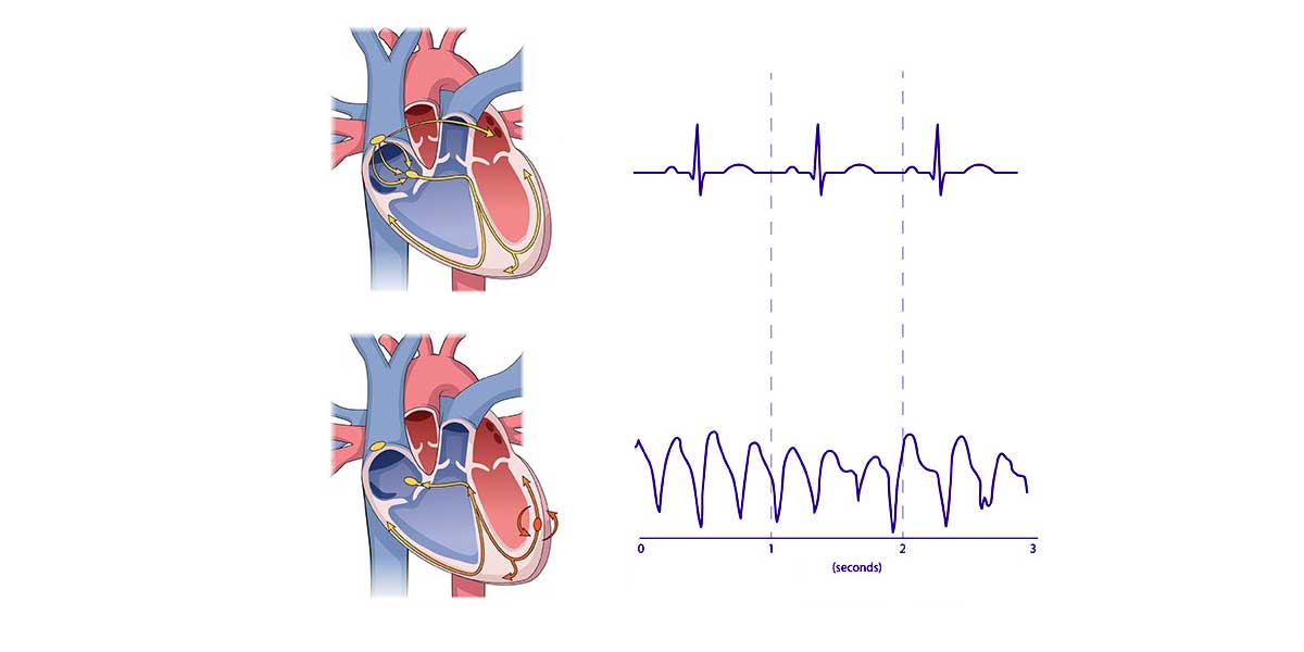 Κατάλυση Υπερκοιλιακών & Κοιλιακών Ταχυκαρδιών - Κολοβός Βασίλειος MD ...